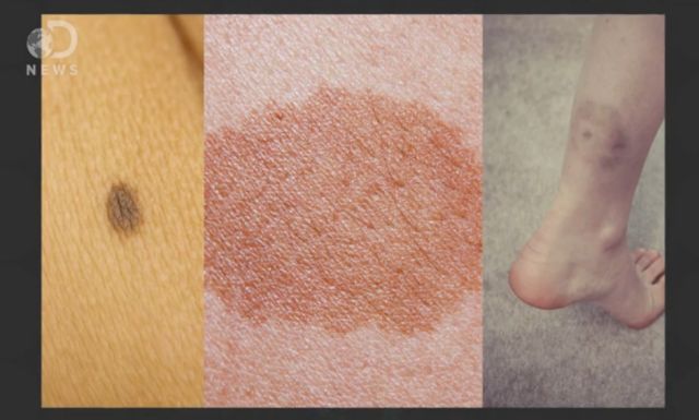 The Real Reason Why Birthmarks Exist | For Human Health