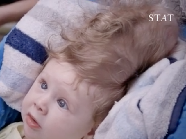 Baby Born Without A Head